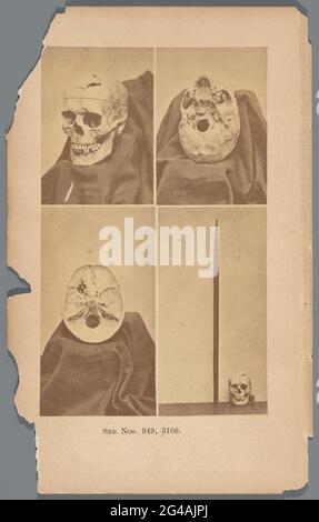 Four views of the skull of Phineas Gage, Anonymous, 1868 photograph ...