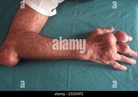 Hand with gout Stock Photo - Alamy