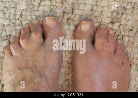 Human foot with conjoined toes Stock Photo - Alamy