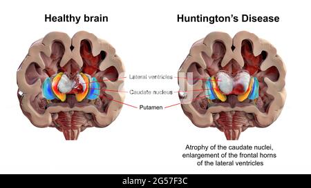 Normal brain and brain in Huntington's disease, illustration Stock ...