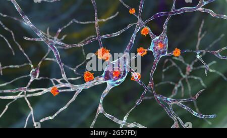 Neuronal inclusions in Huntington's disease, illustration Stock Photo ...