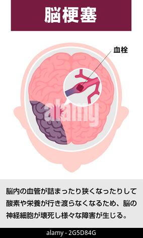 Cerebral infarction. ischemic stroke. human brain with blood vessel on ...