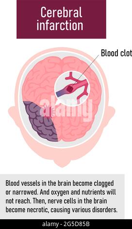 Cerebral infarction. ischemic stroke. human brain with blood vessel on ...