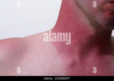 Skin of a person with sunburn, redness of the skin, close-up Stock ...