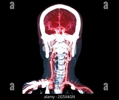 CTA BRAIN or CT angiography of the brain axial mip view showing ...
