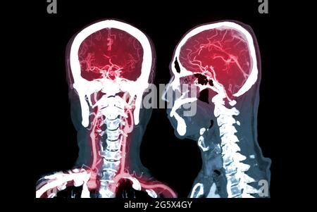 CTA BRAIN or CT angiography of the brain MIP technique image AP and ...