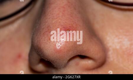 skin problems. problem of inflamed acne on the face. Inflamed acne ...