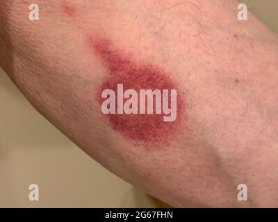 Bullseye Rash on Lower Leg, Six days after bite. Sign of Lyme Disease ...