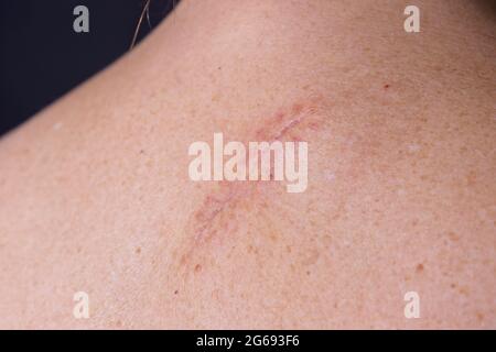 Scar after operation on back of women on white background, big scar on ...