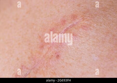 Scar after operation on back of women on white background, big scar on ...