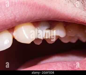 A black dead tooth in which a piece of tooth enamel is chipped off, a ...