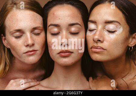 Three women having skin problems standing together on brown background ...