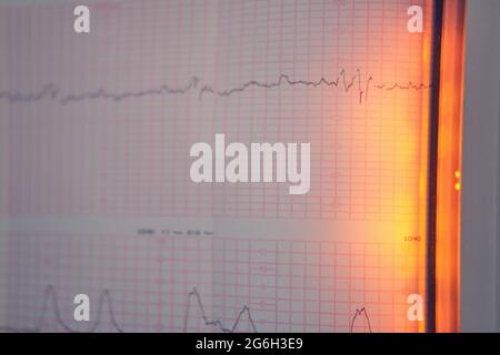cardiotocography machine of hospital with monitor and chart on paper ...