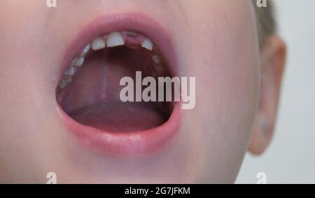 Young woman showing her mouth without tooth on lower jaw. Missing tooth ...