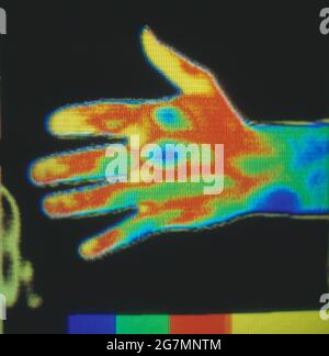 Thermograph (heat image) of a man's hand, showing palm upward. The ...