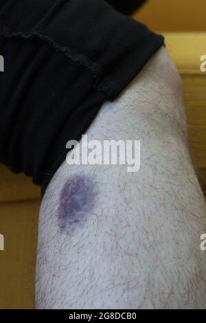 Close up purple bruise on skin. Bruise from impact. Bruising and ...
