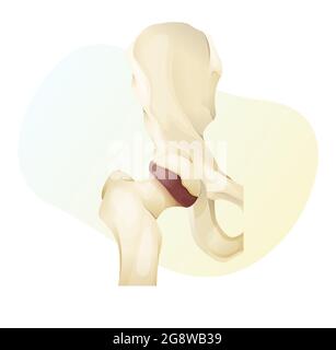 Osteoarthritis - Bone Death - Hip Joint - Stock Illustration as EPS 10 ...