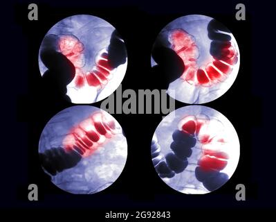 barium enema image or x-ray image of large intestine Prone position ...