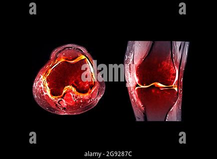 Magnetic resonance imaging of the knee or MRI knee coronal view for ...