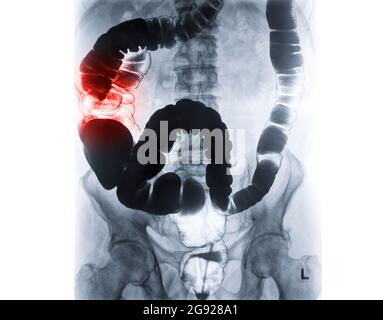 barium enema demonstrated l rectum and colon for diagnosis Colorectal ...