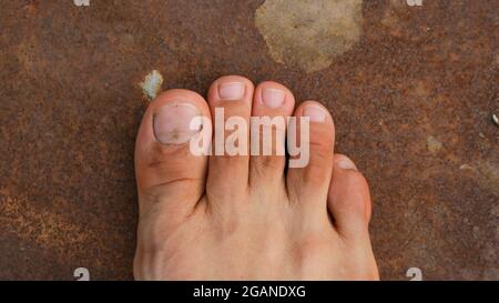 Foot with second toe longer than big toe, which is known as Morton's ...