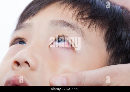 Pinkeye (conjunctivitis) infection on a little asian (thai) boy, doctor ...