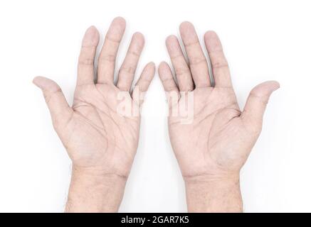 Pale palmar surface of hands. Anaemic hands of Asian, Chinese man ...