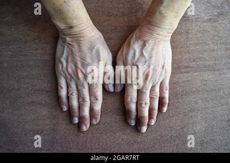 Cyanotic hands or peripheral cyanosis or blue hands at Southeast Asian ...