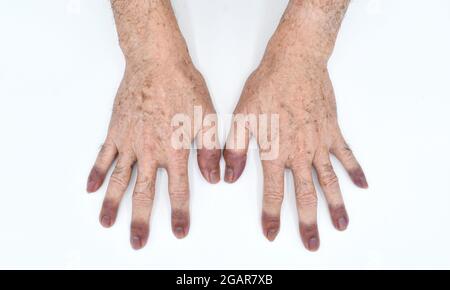 Cyanotic hands or central cyanosis or blue hands at Southeast Asian ...