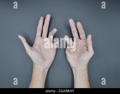 Ulnar claw hand of Asian young woman. also known as 'spinster's claw ...