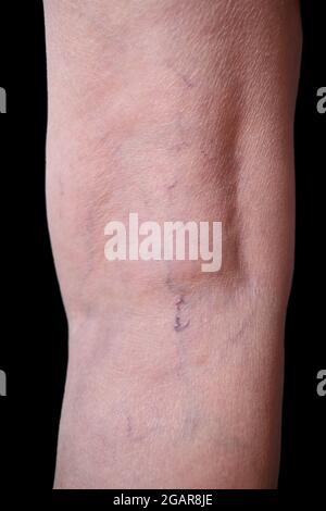 Southeast Asian, Myanmar old woman’s forearm. Skin creases, loosen skin ...