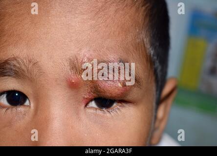 Painful carbuncles or cellulitis or Staphylococcal / Streptococcal skin ...