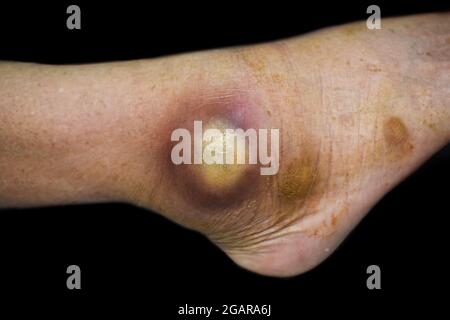 Large abscess and cellulitis at foot of Asian Burmese elderly male ...
