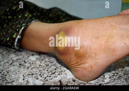 Bacterial cells of Staphylococcus aureus Stock Photo - Alamy