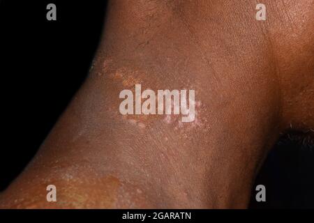 Pityriasis versicolor (tinea versicolor), a fungal infection producing ...