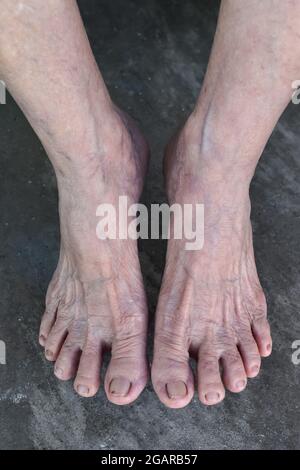 Dry skin on heel. Female feet turned up, sole care, moisturizers and ...