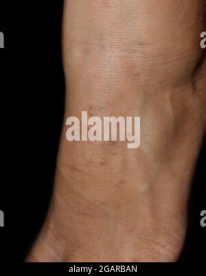Scar on skin of upper leg representing healed lesion of leishmaniasis ...