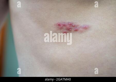 Shingles (Disease), Herpes zoster, varicella-zoster virus. skin rash ...