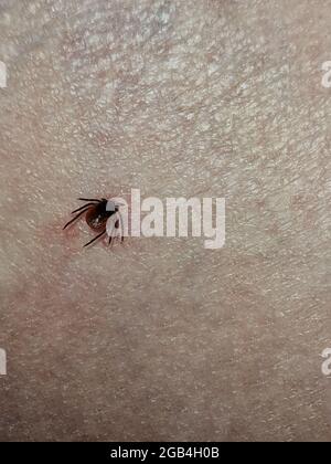 Tick with its head sticking in human skin Stock Photo - Alamy
