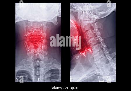 Esophagram or Barium swallow showing esophagus for diagnosis GERD or ...