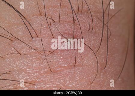 Inflammation caused by ingrown hair on the big toe in macro view Stock ...