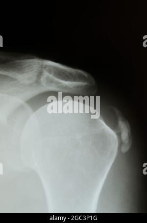 Calcific tendinitis, X-ray Stock Photo - Alamy