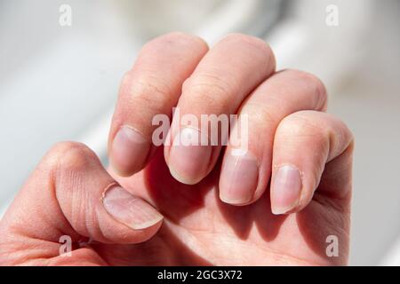 CUTICLE nail finger problem medicine skin Onychitis disease medical ...