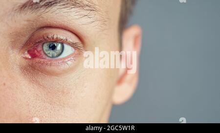 Eye infection. Close-up of an eye affected by viral conjunctivitis. The ...