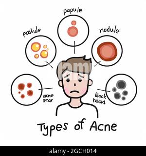 Acne Types Vector. Man With Acne. Facial Skin Problems. Papule ...