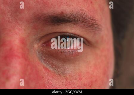 Caucasian male's face becomes red and itchy because of eczema Stock ...