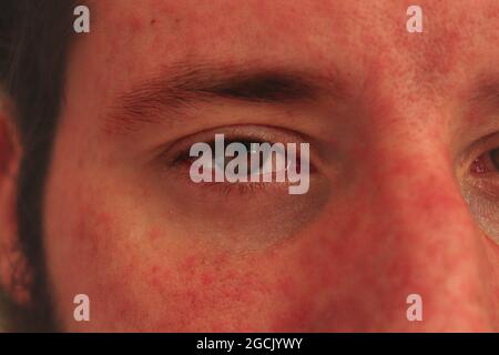 Caucasian male's face becomes red and itchy because of eczema Stock ...