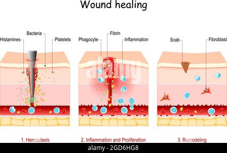 wound healing process. Hemostasis, Inflammatory, Proliferative ...