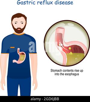 Stomach heartburn. Gastritis and acid reflux, indigestion and stomach ...