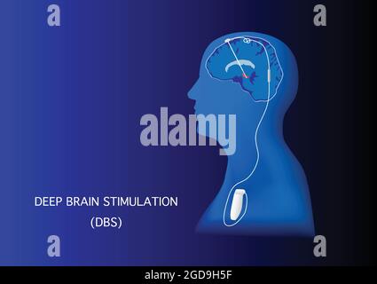 Deep brain stimulation at subthalamic nucleus for treatment of ...